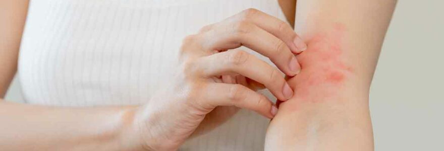 Traitements médicaux efficaces pour la dermatite atopique : Symptômes ...